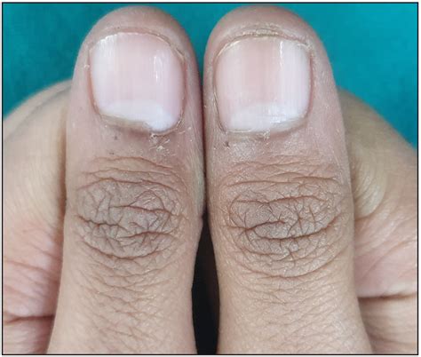 Clinical Characteristics And Management Outcomes In Isolated Nail