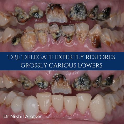 Dre Composite Course On Linkedin Dentistry Compositebonding Restorativedentistry