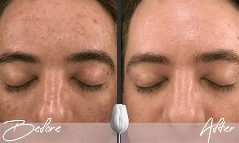 Microneedling For Acne Scars Wrinkles And Hyperpigmentation