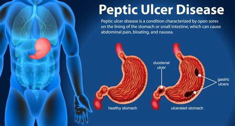 Peptic Ulcer Treatment In Mumbai Dr Pradeep Shriyan 💊🏥