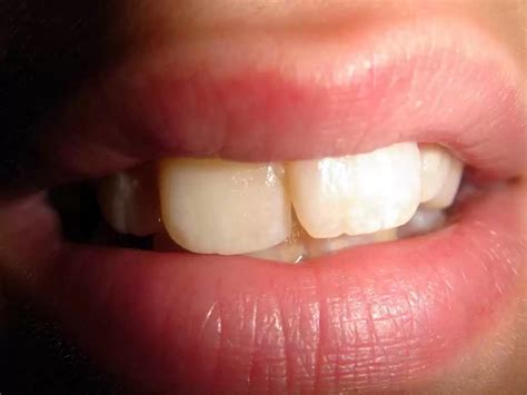 Celiac Disease Teeth
