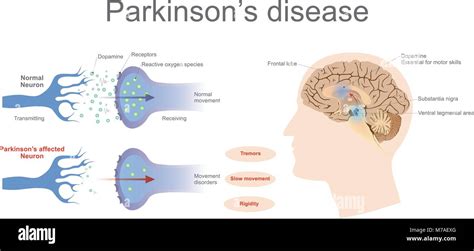 Parkinsons Disease And Dopamine At Beth Meeks Blog