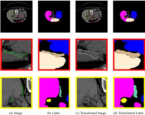 [논문 리뷰] Shape Transformation Driven By Active Contour For Class Imbalanced Semi Supervised