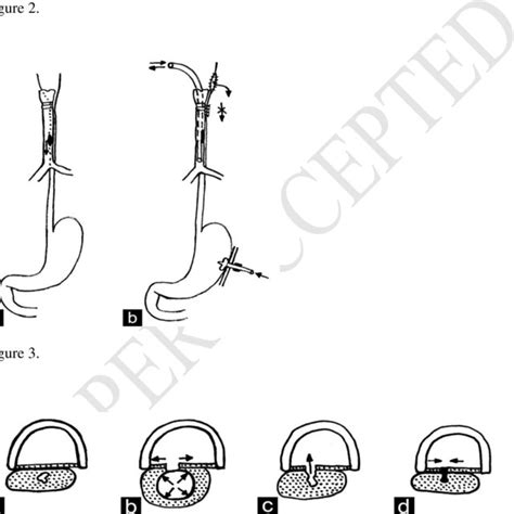 Zargar Endoscopic Classification Scheme For Caustic Mucosal Injury