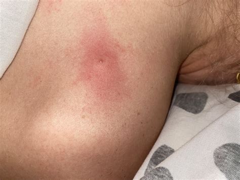 Took A Photo Of My Girlfriends Back Pimple While She Was Face Down Her Mum Was A Bit Confused