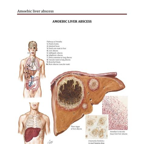 Amoeric Liver Abscess Doc Docdroid