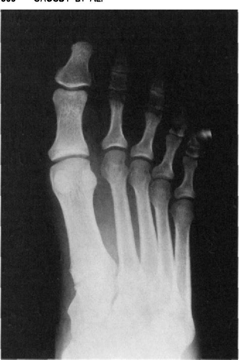 Figure 1 From Irreducible Dorsal Dislocation Of The Great Toe