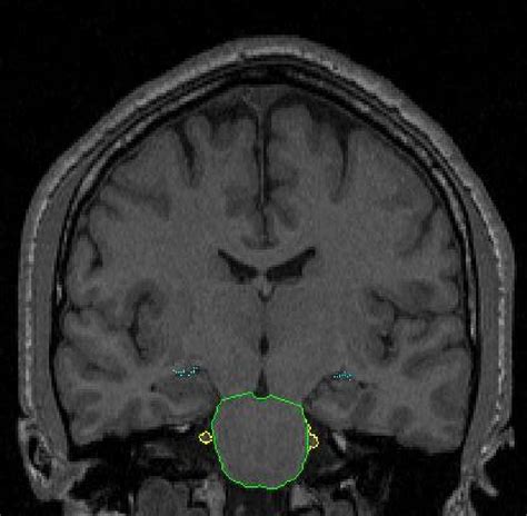 Segmentation Brainstem