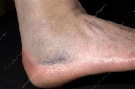 Fractured Ankle Bone Stock Image M3301442 Science Photo Library