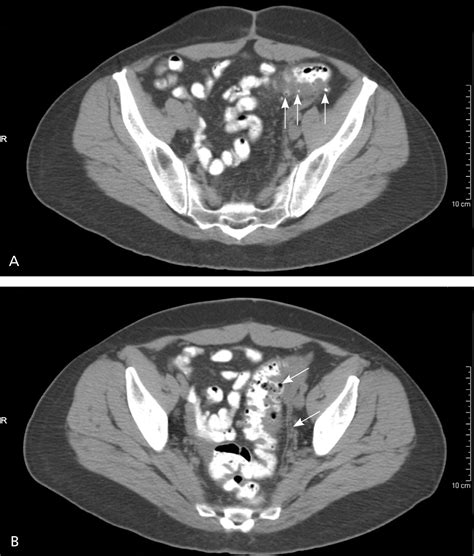 Diagnosis And Management Of Acute Diverticulitis