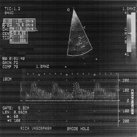 Transcranial Doppler Flow Waveform Showing Right Internal Carotid Download Scientific Diagram