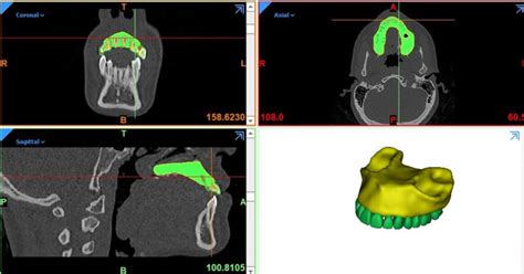 Segmentation Of Bones And Teeth In The Ct Scan Volume Download Scientific Diagram
