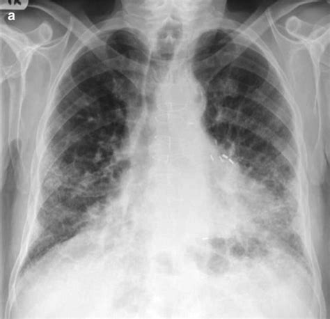 Interstitial Lung Disease X Ray