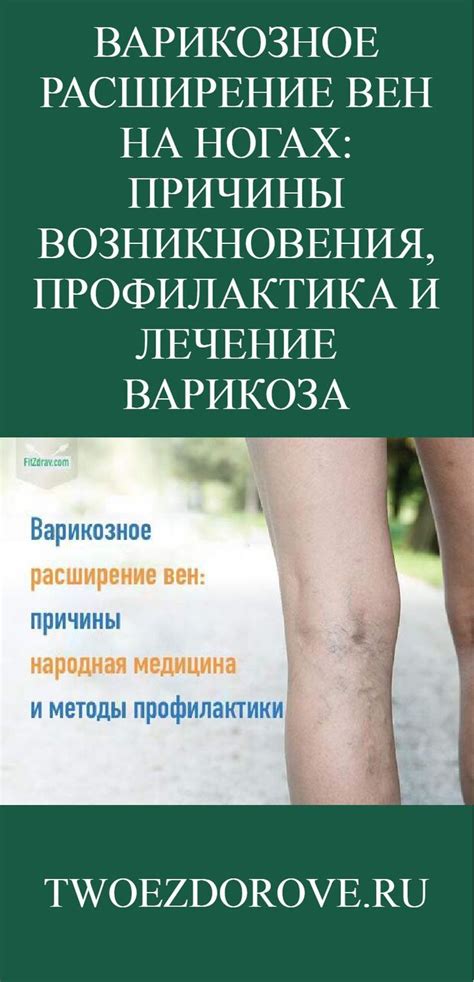 Варикозное расширение вен на ногах причины возникновения профилактика