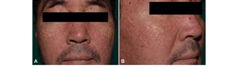 A B Yellowish Distinct Papular Eruption With Acneiform Rash On The