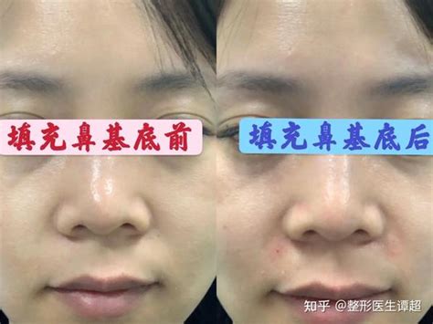 鼻基底和法令纹有什么区别你真的分得清吗 知乎