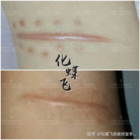 刀伤缝合拆线后增生了怎么办 知乎