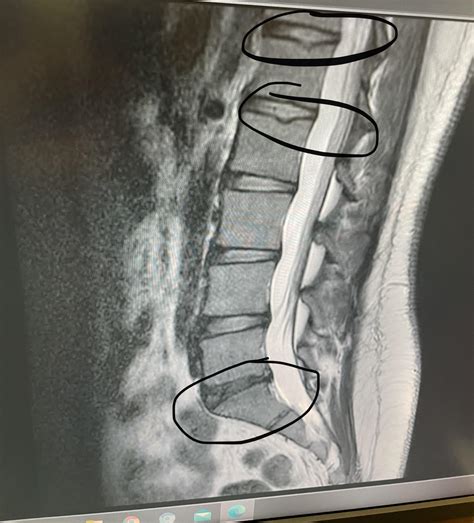 Finally Got The Picture Of My Mri Top Two Are Schmorls Nodes And The Bottom Is L5 Si Herniation