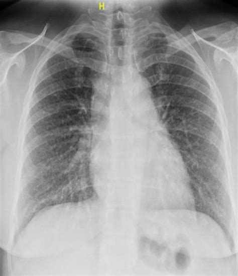 Chest X Ray Showing Diffuse Reticular Interstitial Shadowing