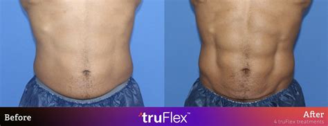Truflex Build Muscle Mass Eterna Cosmetic San Antonio Tx
