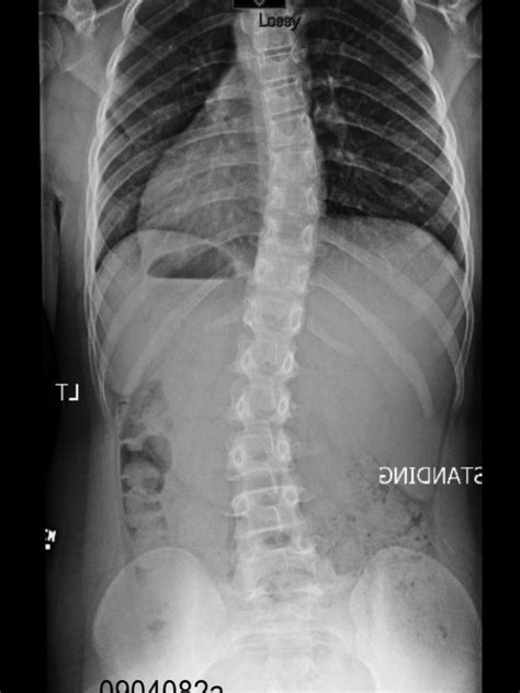Spinal Tech Providence Nocturnal Scoliosis® Orthosis