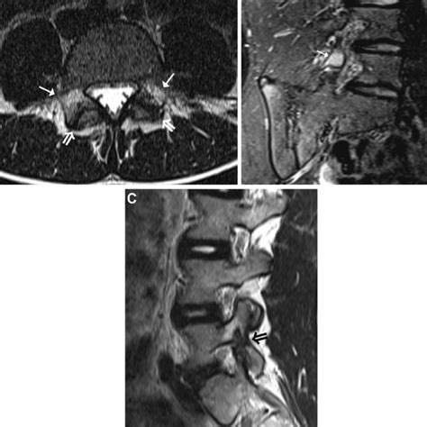 Bilateral L4 Pars Defect Arrows On Computed Tomography Ct A Download Scientific Diagram