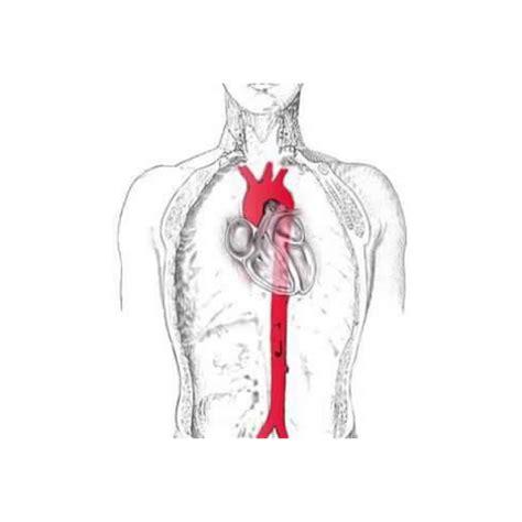 Sindrome Aortica Acuta Saa Isfai