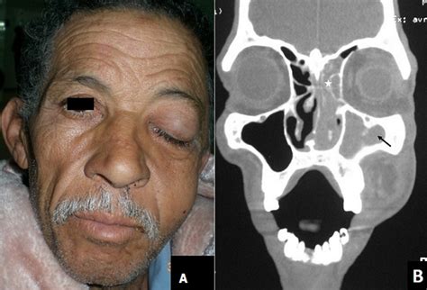 Rhinocerebral Mucormycosis