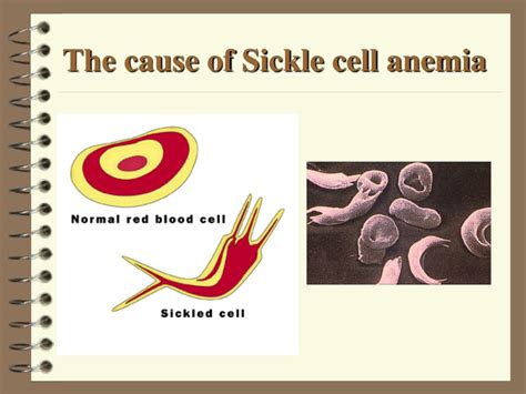 Ppt Sickle Cell Anemia Powerpoint Presentation Free Download Id