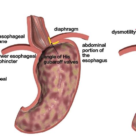 Anti Reflux Barrier Disruption At The Esophageal Junction A And B In Download Scientific