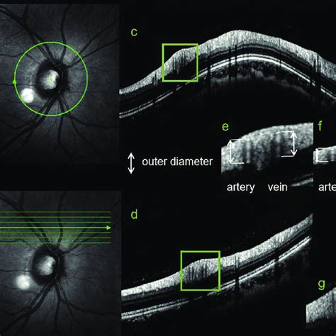 Measurement Locations And Retinal Vessel Cross Sections A B Infrared