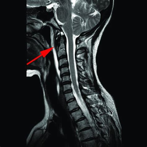 Details Of Findings On X Ray Loopogram Colonoscopy And Postoperative Download Table Details Of Findings On X Ray Loopogram Colonoscopy And Postoperative Download Table