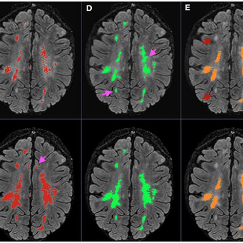 Multiple Sclerosis Brain Mri Lesion Segmentation Kaggle