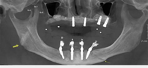 Cbct Panoramic Reconstruction Demonstrating Right The Trifid Coronoid Download Scientific