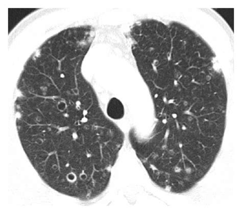 Axial Thoracic Ct Lung Window Multiple Bilateral Pulmonary Nodules Download Scientific