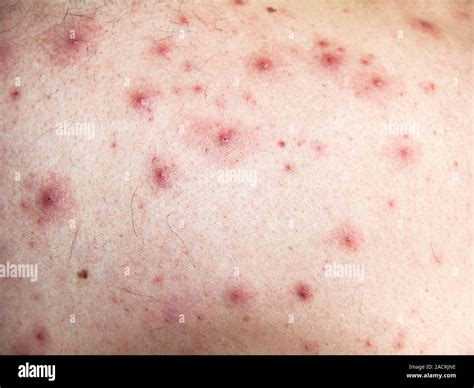 Acne Pustules Close Up Of A Mans Upper Back And Shoulder Area Showing Small Pustules Due To