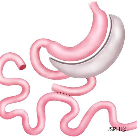 Sleeve Gastrectomy With Jejunojejunal Bypass Download Scientific Diagram