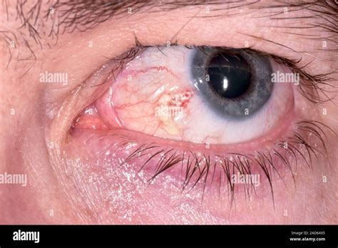 Molls Cyst In The Eyelid Close Up Of A Molls Cyst On The Lower