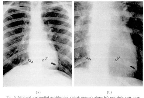 Figure 1 From The Roentgenologic Appearance Of Pericardial Calcification Semantic Scholar