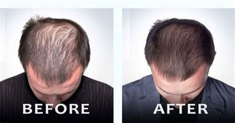 თმის ცვენის საწინააღმდეგო ნიღაბი მხოლოდ ბუნებრივი ინგრედიენტებით სასარგებლო რჩევები