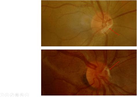 Glial Tissue Fundus Photographs Of Optic Disc Glial Tissue In Two