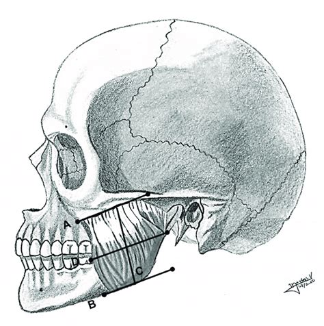 Dimensions Of The Masseter Muscle In Relation To Segments A Superior