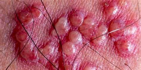 Identifying The Std Behind Bumps On The Buttocks A Spotlight On Genital Herpes