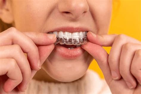 What Does A TMJ Splint Look Like Vista Family Dentistry