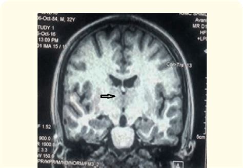 Suprasellar Cisterns