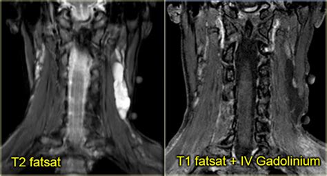 Mri Neck Anatomy Free Mri Axial Neck Cross Sectional Anatomy Mri Neck Anatomy Free Mri Axial Neck Cross Sectional Anatomy