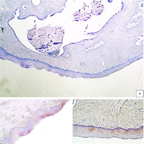 Different Patterns Of Positive P16 Staining In Cin I Lsil Upper Line