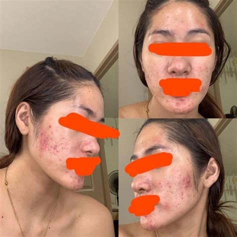 Non Stop Acne I Dont Know What To Do With My Acne Anymore Im Feeling So Depressed I Am Tired