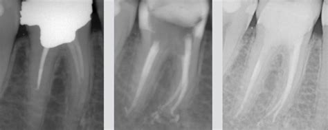 Overfilling Endodontic Failure Vs Clinical Success Style Italiano