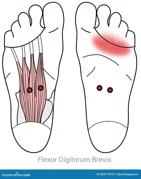 Flexor Digitorum Brevis Stock Illustration Illustration Of Digitorum